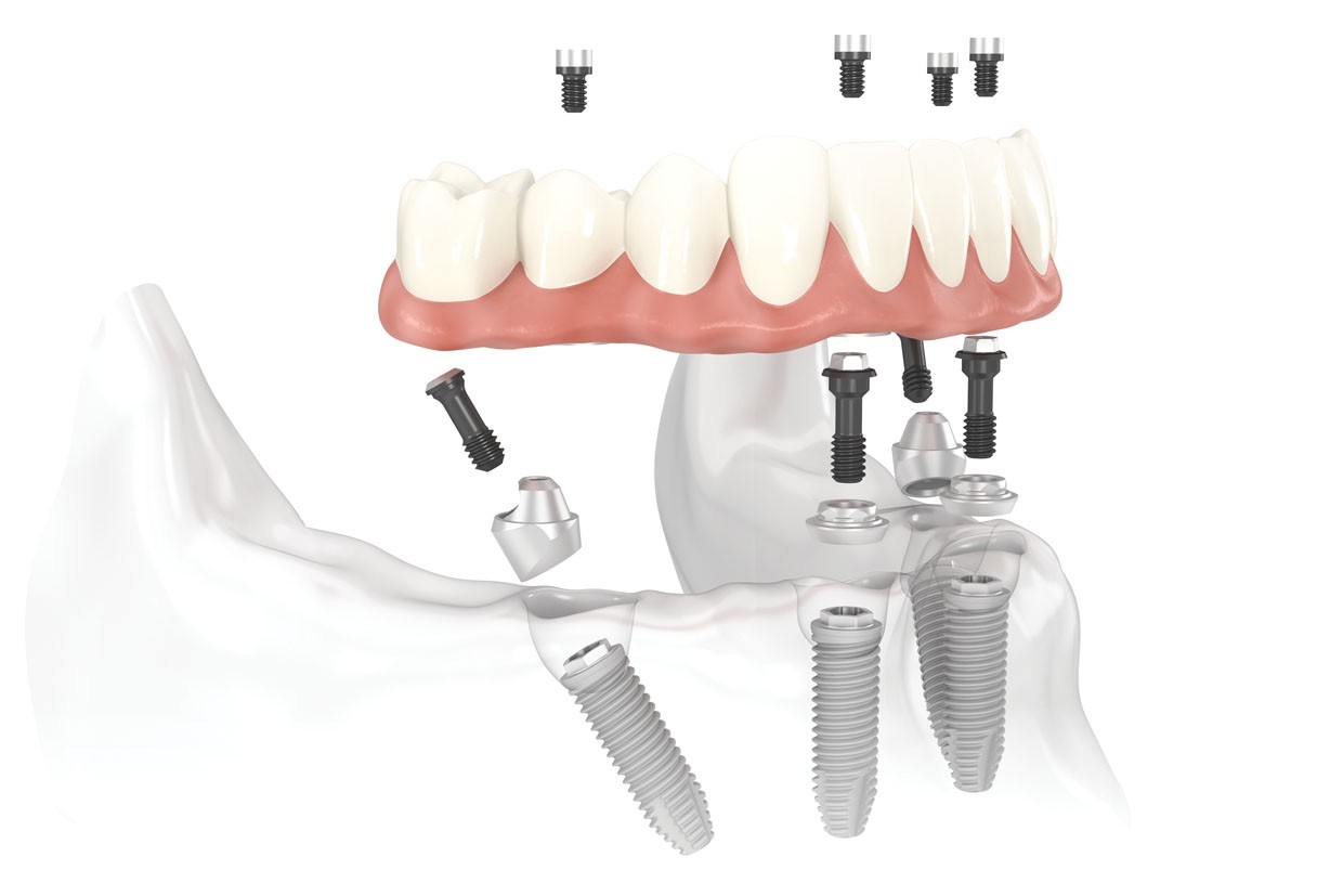 Full arch implants in Leeds - HQ Dental