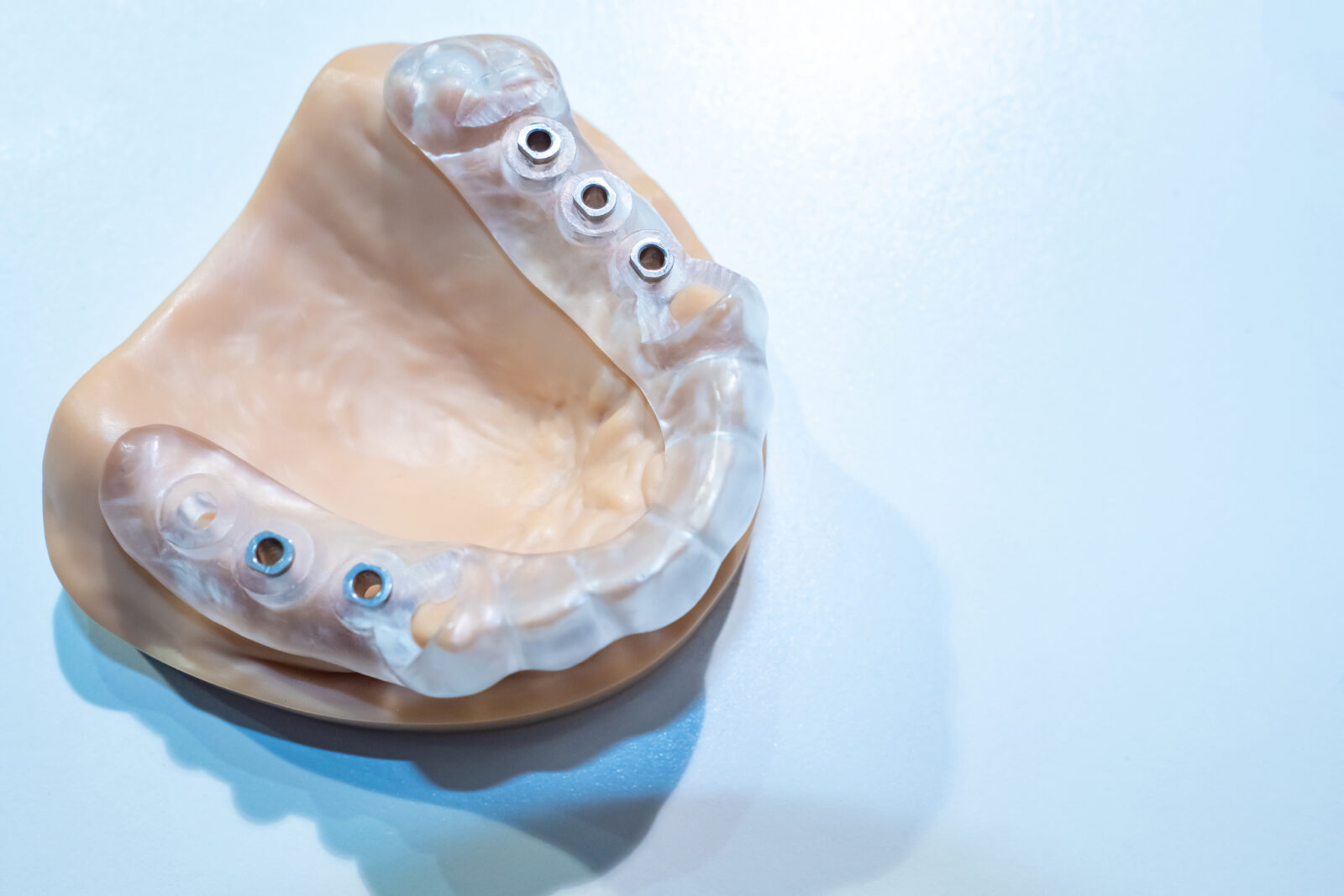 Guided Implants Leeds | Dental Implants | HQ Dental