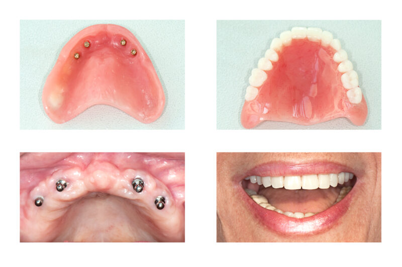 Implant Retained Dentures | HQ Dental, Leeds, UK